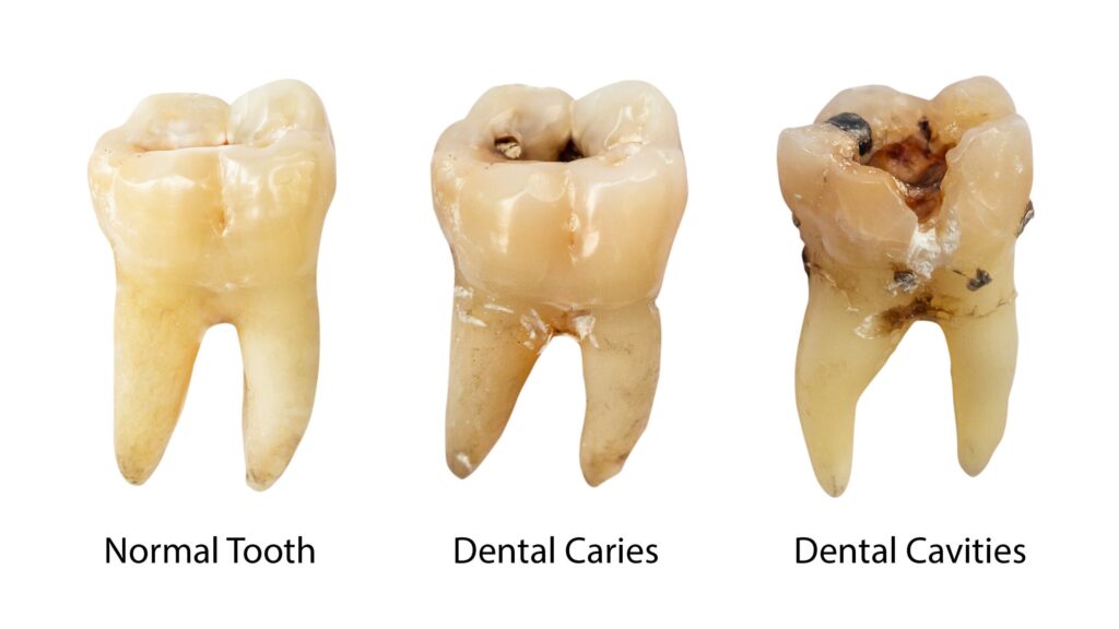 Symptoms and Treatment of Tooth Decay